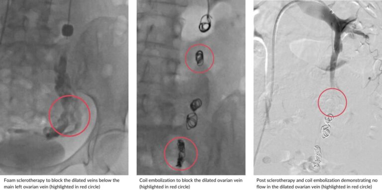 Pelvic Congestion Syndrome The Vascular And Endovascular Clinic