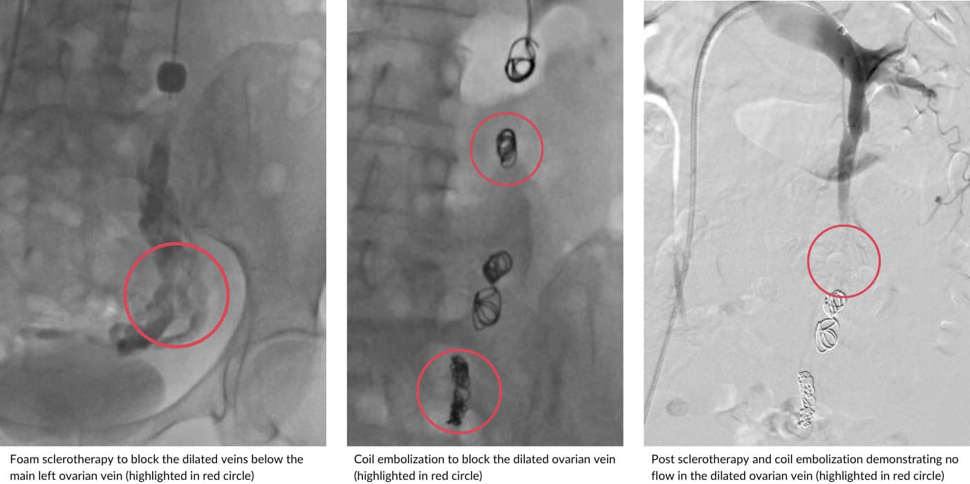 Pelvic Congestion Syndrome The Vascular And Endovascular Clinic