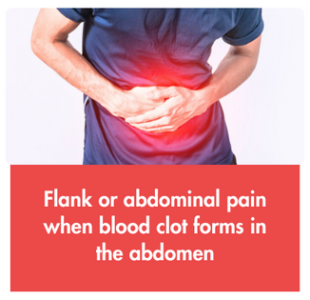 The Role of Suction Thrombectomy for Deep Vein Thrombosis