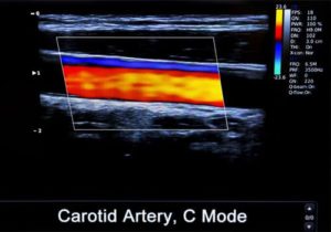 Screening - The Vascular & Endovascular Clinic