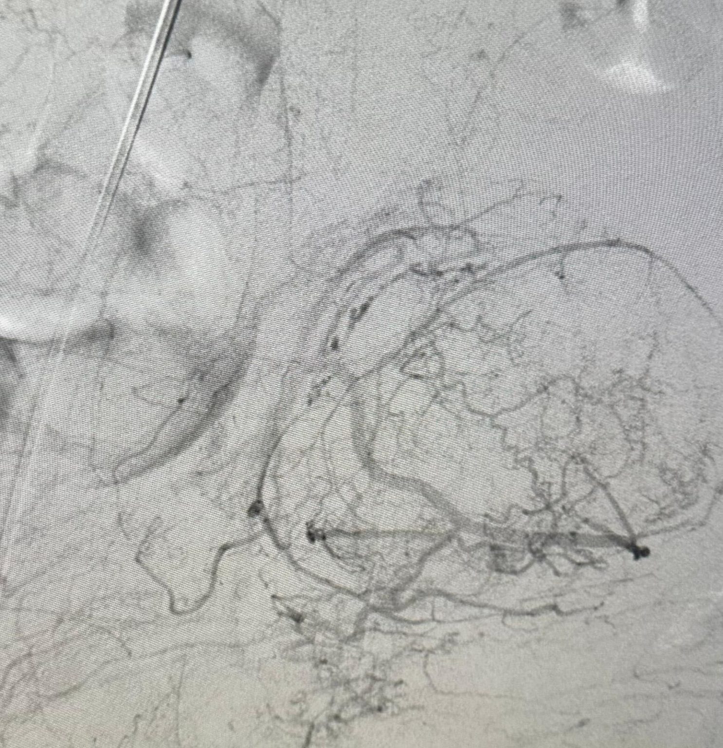 Fibroids - The Vascular & Endovascular Clinic
