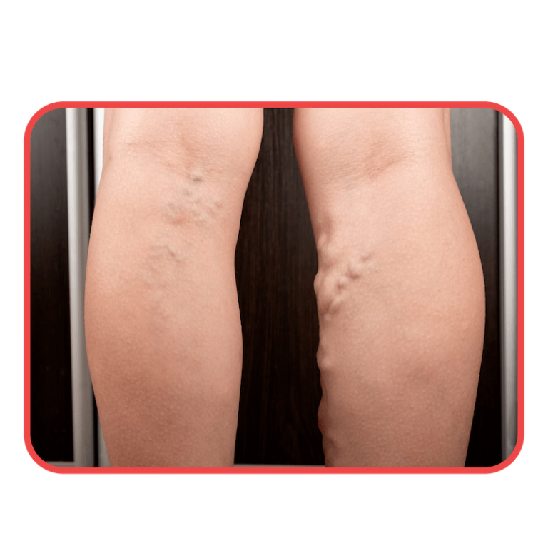 Leg Swelling Causes and Symptoms: When to Seek Medical Care?