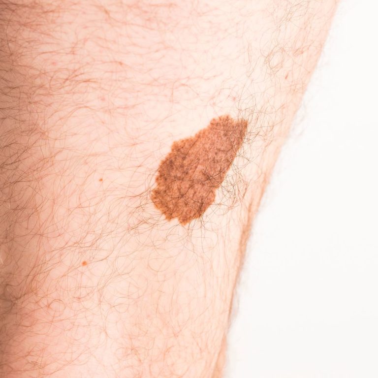 Brown Pigmentation on the Legs: Causes and Treatments