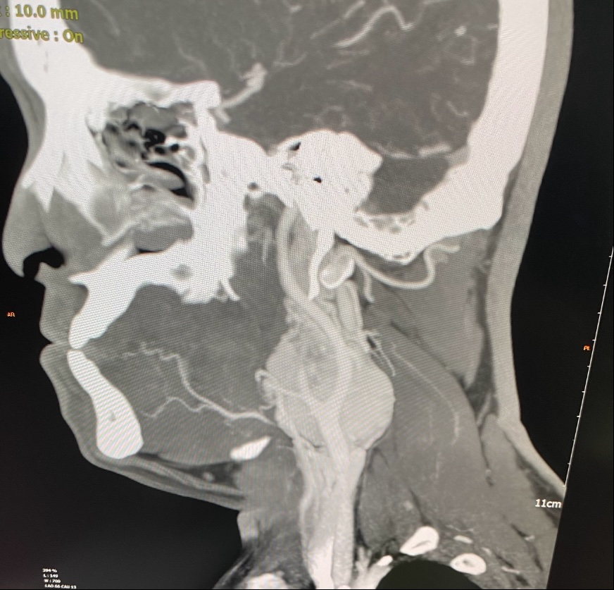 Frequently Asked Questions Carotid Body Tumour