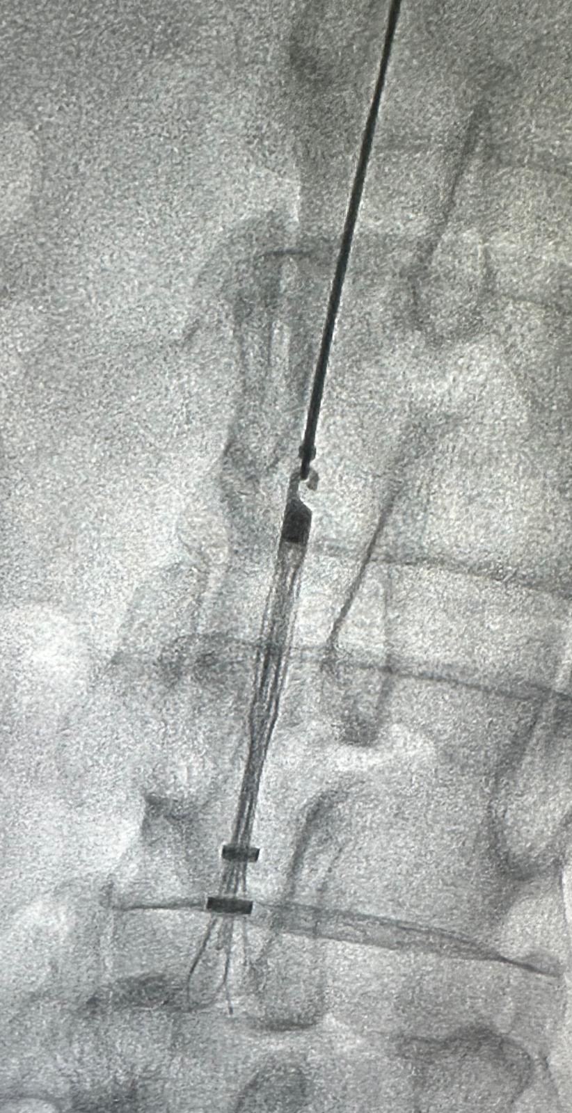 What is an IVC Filter?
