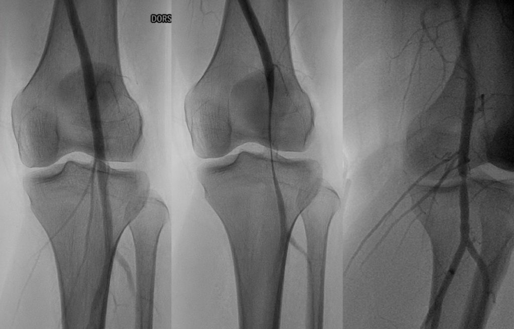 Popliteal Entrapment & Chronic Compartment Syndromes - The Vascular ...