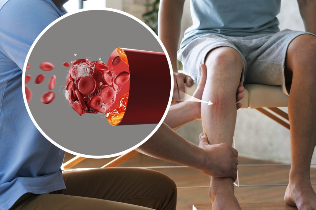 Varicose Veins: Symptoms, Causes, and Treatment - The Vascular ...