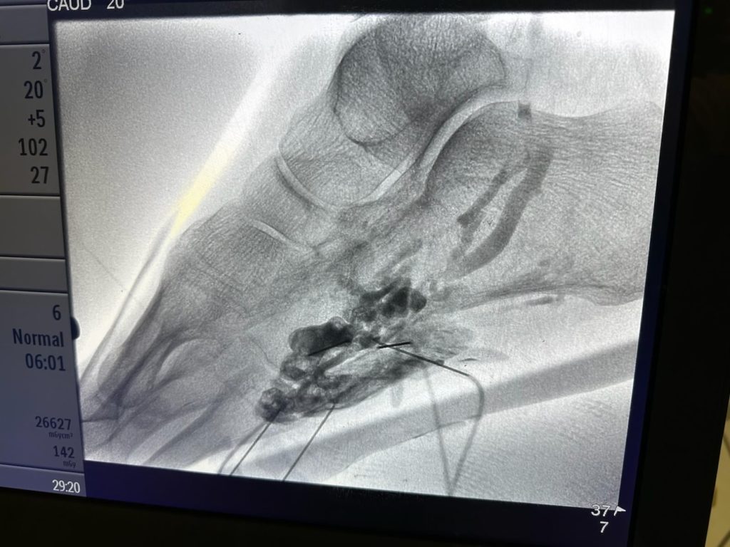 What is a Venous Malformation? - The Vascular & Endovascular Clinic