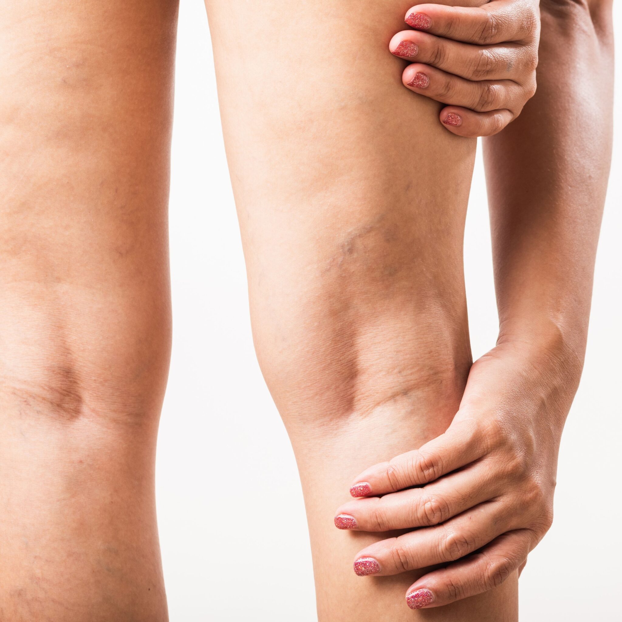 Beyond Chronic Venous Insufficiency: Understanding Cellulitis and When ...
