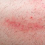 Beyond Chronic Venous Insufficiency: Understanding Cellulitis and When ...