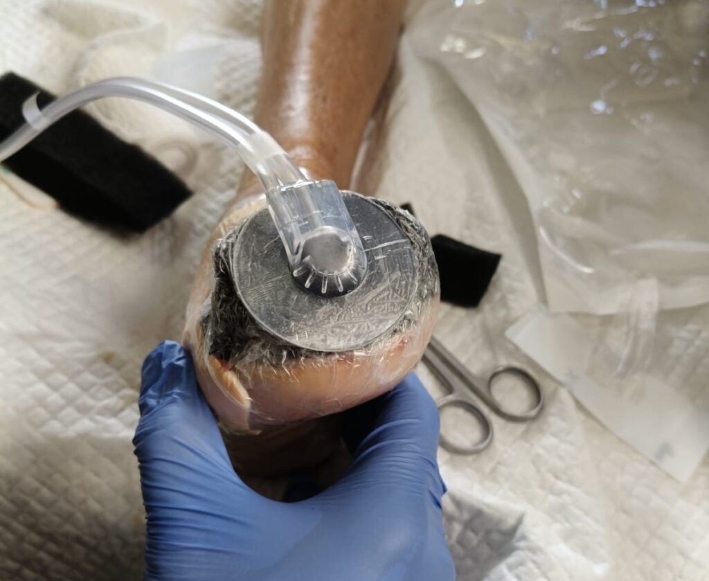 The Science Behind Vacuum Therapy and Its Benefits for Wound Care